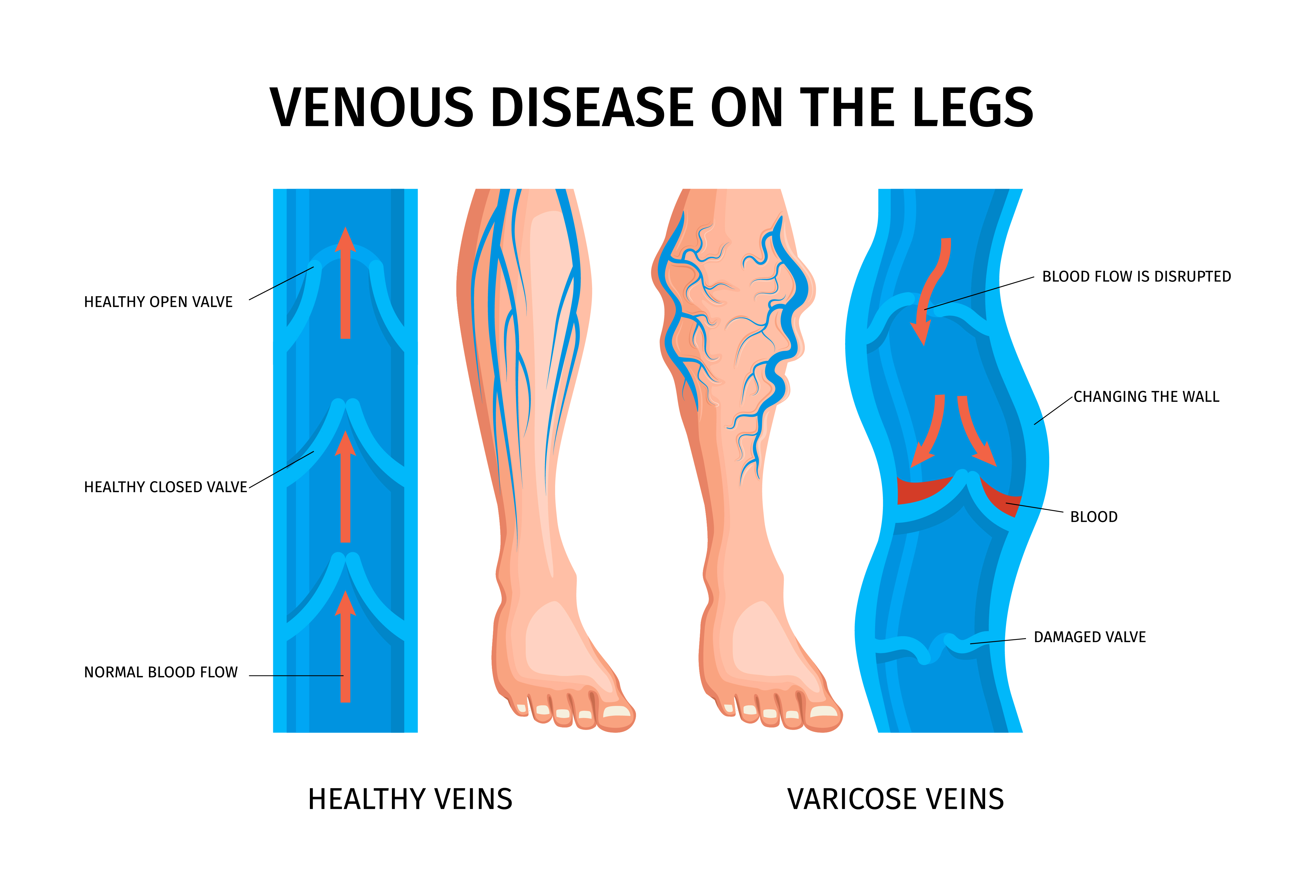 Best Doctor for Varicose Veins in Mumbai | Varicose Veins Specialist